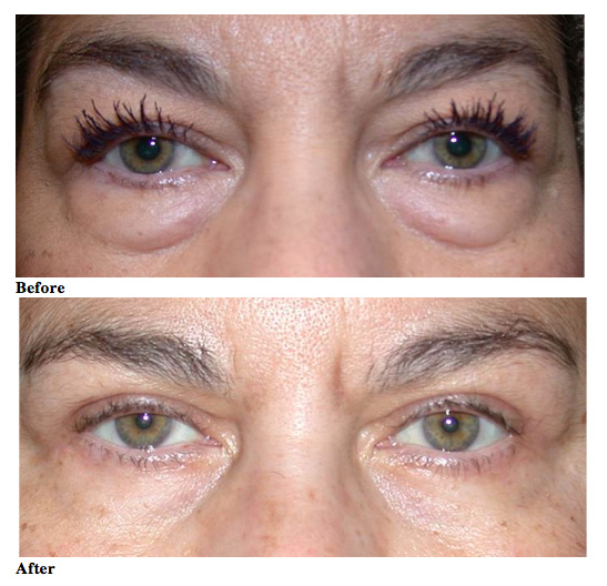 Blepharoplasty Eyelid Surgery Richmond, VA | Minimal Recovery Time