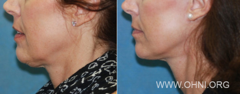 Micro-Mini Lift By Dr. Godin | Minimally-Invasive Facelift